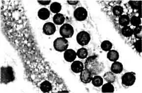 Ileus (obstrucție intestinală) cauzată de blocarea ouălor Artemia